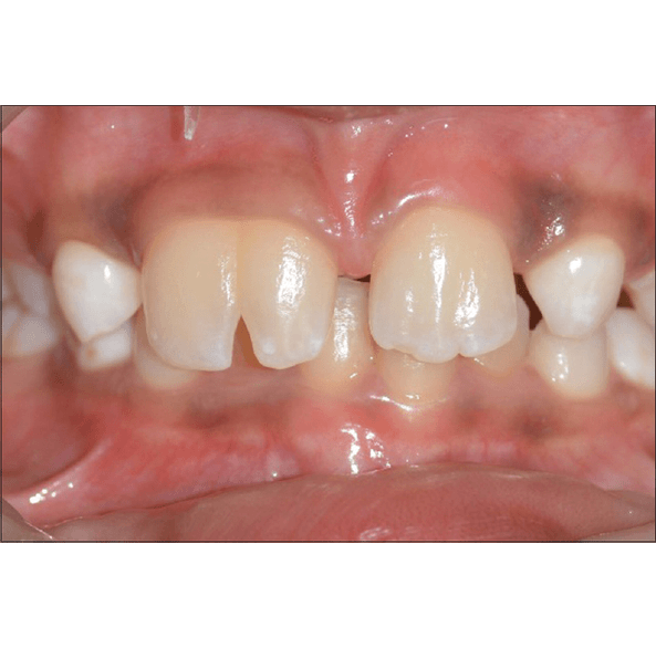 How To Treat Fusion Of Maxillary Anterior Teeth Macrodontia PART 1 How To Treat Fusion Of Maxillary Anterior Teeth Macrodontia PART 1